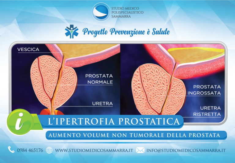 Ipertrofia Prostatica a Cosenza e Rende – Studio Medico Sammarra